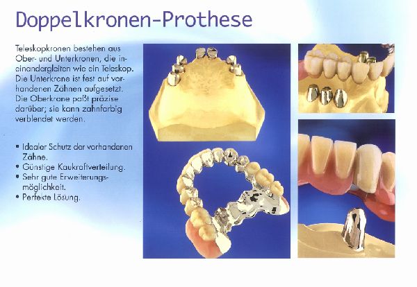 Teleskopkronen- Prothese | Boger Zahntechnik
